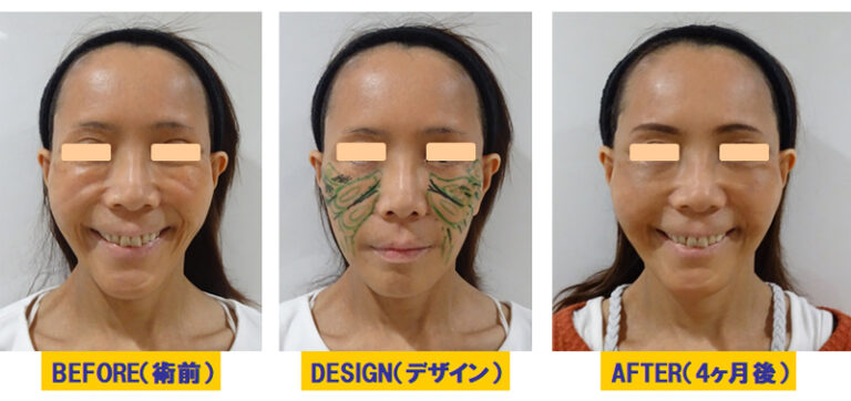 異物除去「他院でFGF・グロースファクターを含む顔面の複合手術後に生じた笑顔時の凸凹を切らずに治療」編 | 美容整形の他院修正治療なら美容外科Kunoクリニック